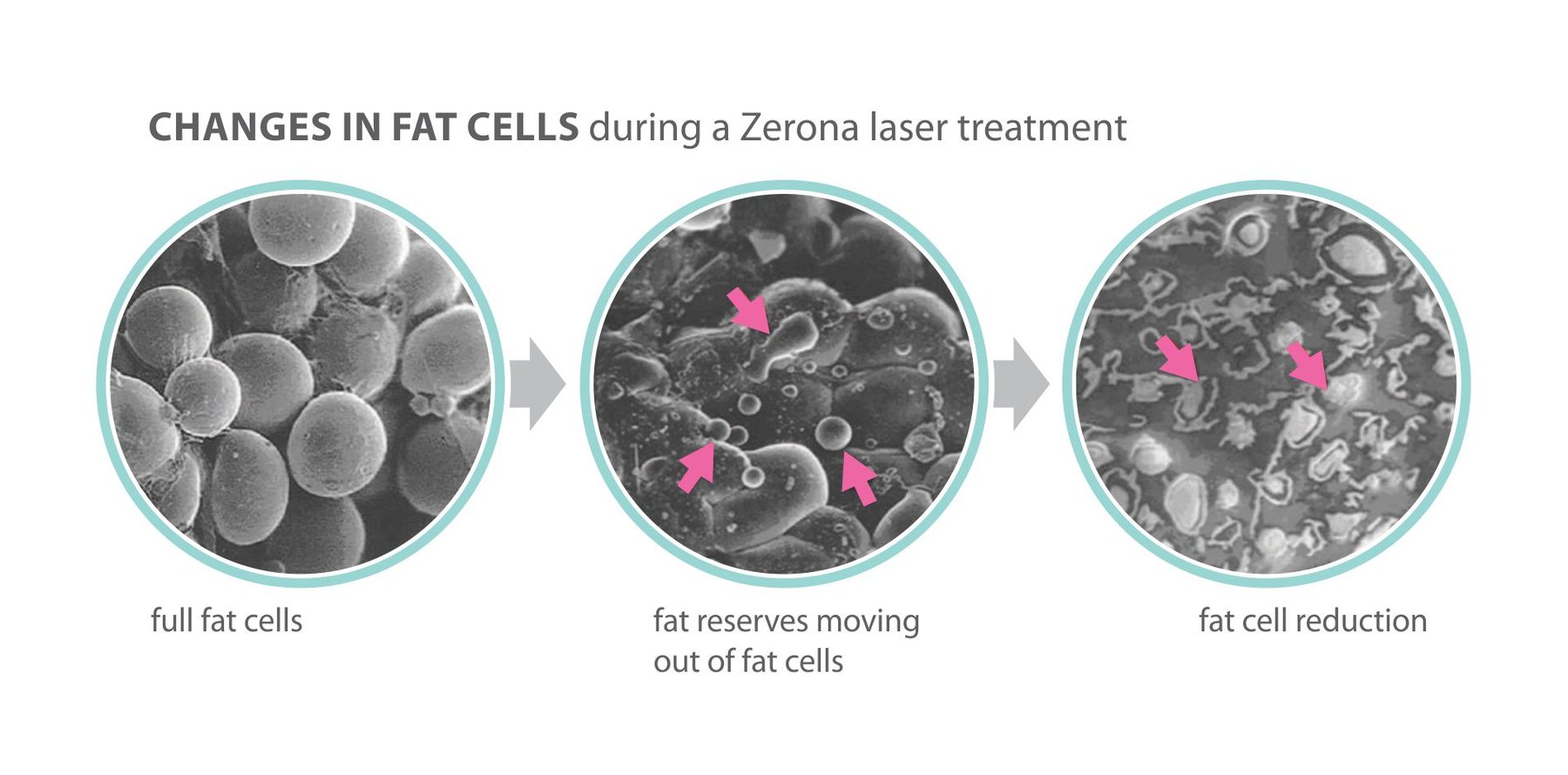 Zerona Laser Therapy in Lawrence Township, NJ | Princeton Integrative ...